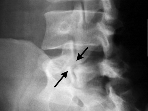 Spondilolisi: diagnosi e trattamento - FisioScience Medical